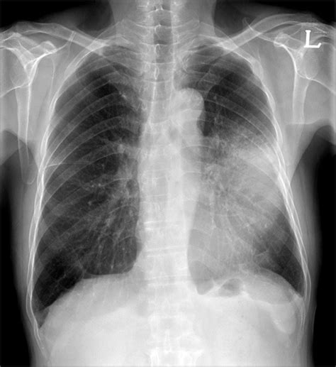 What Does Opacity Mean In Chest X Ray At Caleb Jonathan Blog