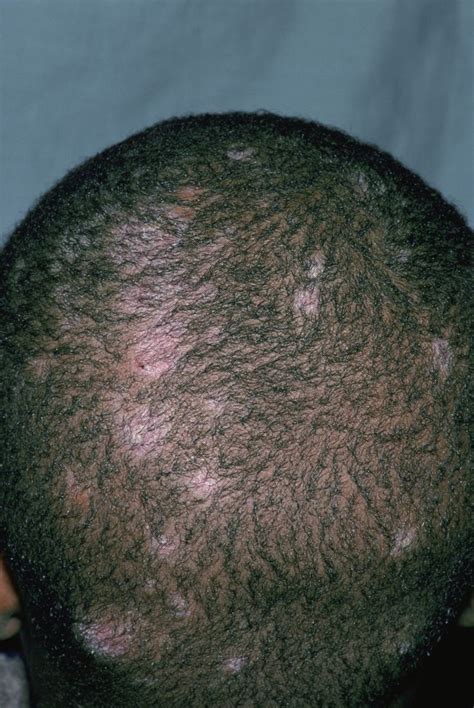 7 Common Scalp Issues And How To Treat Them Scalp Hea