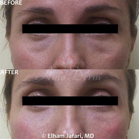 Treat Dark Circles And Bags Under Eyes Using Fillers And Lasers