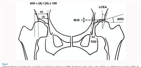 Figure 1 From The Modified Spitzy Shelf Acetabuloplasty For The