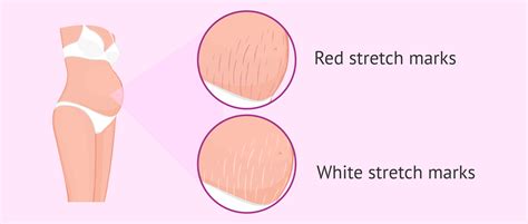 Pregnancy Stretch Marks Genetic 9 Natural Stretch Mark Treatments