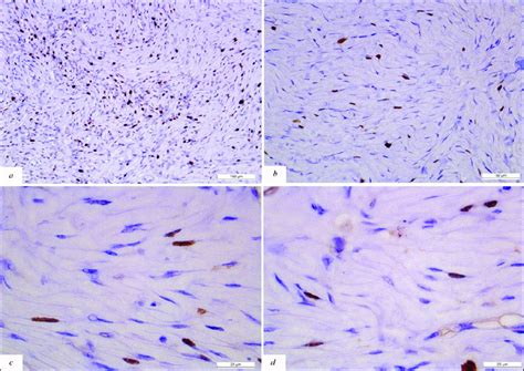 Immunohistochemical Typing Of Proliferative Activity Of Connective
