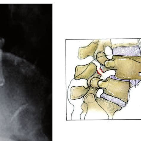 Lateral Plain X Ray Radiograph And Illustration Of Spondylolysis With Download Scientific