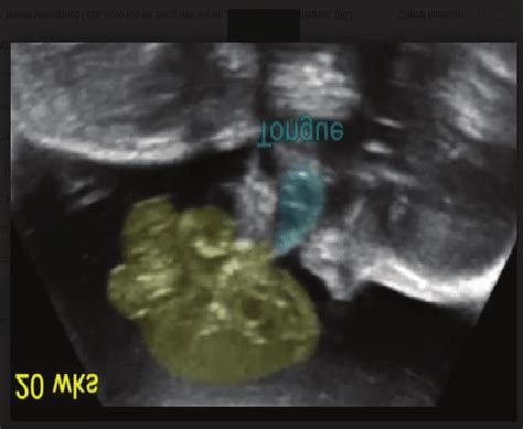 Shows Complex Mass Green Color Protruding From The Fetal Oral Cavity Download Scientific