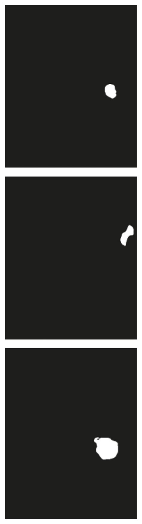 Tumor Segmentation Results Of Different Cnns A Image B U Net C Download Scientific