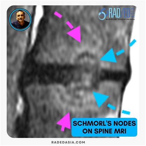 How To Identify Schmorls Nodes On Mri Dr Ravi Padmanabhan Posted On