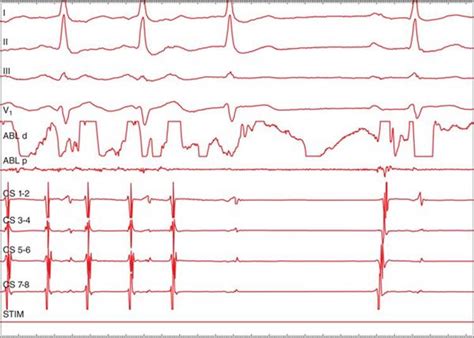 Analysis Of Challenging Intracardiac Electrograms Case Ii Focal Versus Macroreentrant Atrial