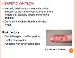 Hand Abscess Seminar Pptx