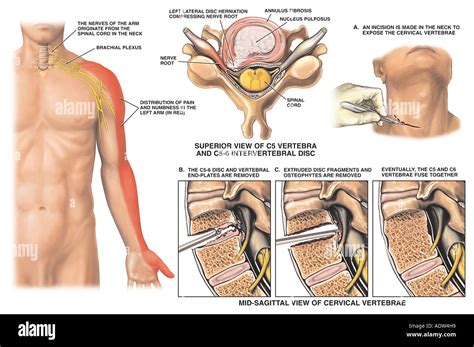 C5 C6 Prolapsed Disc With Nerve Impingement Bkyjl