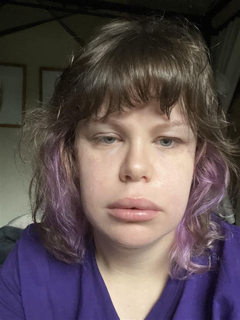 Sudden Nsaid Allergy Thanks To Hives R Hives