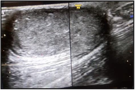 Epidermal Inclusion Cyst In Male Breast A Common Benign Lesion At A