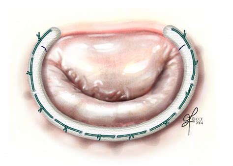 Mitral Valve Repair A New Choice