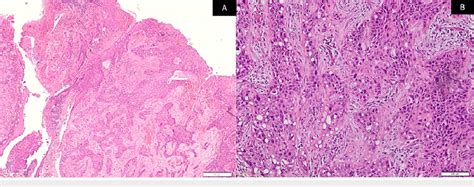 Photomicrograph Shows A Sheets Of Infiltrating Squamoid Tumor Cells Download Scientific