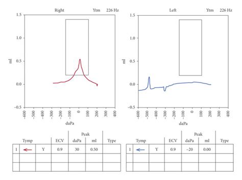 Tympanogram Showing Type A For The Right Ear And Type B For The Left Ear Download Scientific