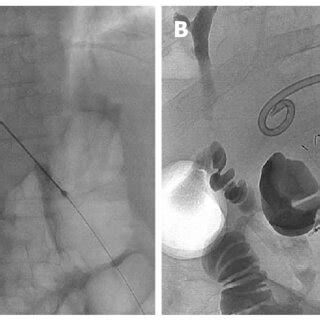Cholangiogram Procedure