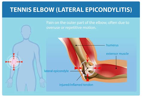 Lateral Epicondylitis Signs And Symptoms