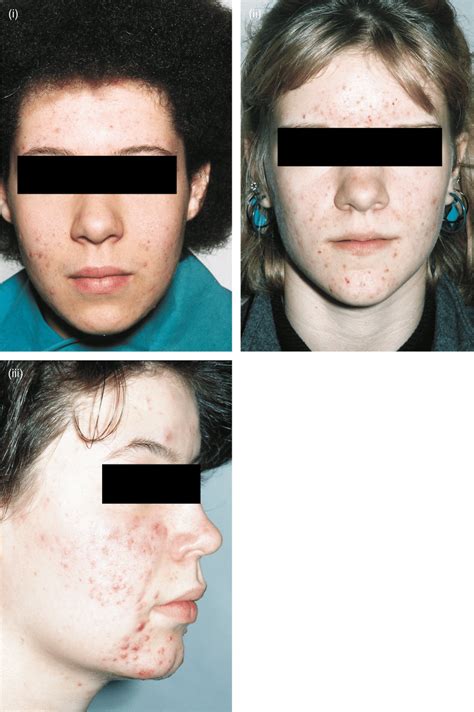 Acne Grading Scale I Mild Ii Moderate And Iii Severe Download Scientific Diagram