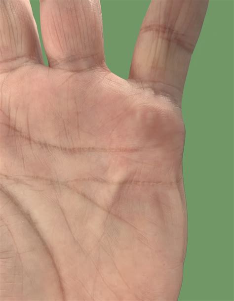 Dupuytrens Nodules Fife Virtual Hand Clinic