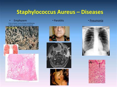 Staphylococcus Aureus Symptoms