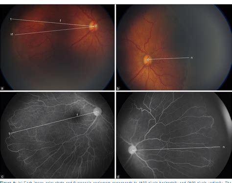 Figure 1 From Relationship Between Refractive Outcomes And Quantitative Retinal Vascularization