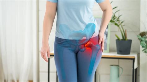 ︎ Bursitis De Cadera Síntomas Y Tratamientos En 2025