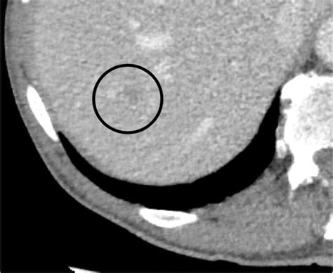 Ct Noise Reduction Methods For Lower Dose Scanning Strengths And Weaknesses Of Iterative