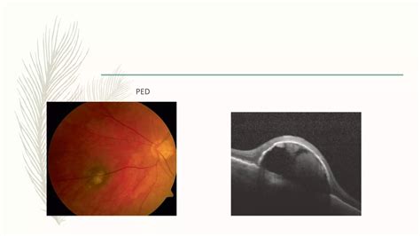 Choroidal Nevus And Chrpe Pptx