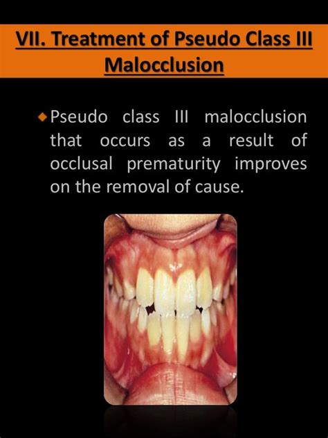Class Iii Malocclusion