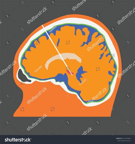 Illustration Deep Brain Stimulation Subthalamic Nucleus Stock Vector Royalty Free 1615797838