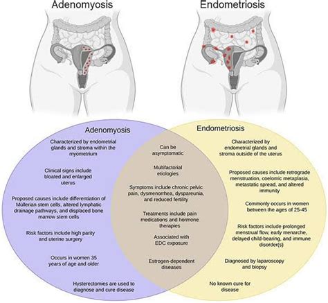 Adenomyosis And Endometriosis Medizzy