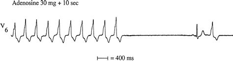 Adenosine Ekg Strip Images