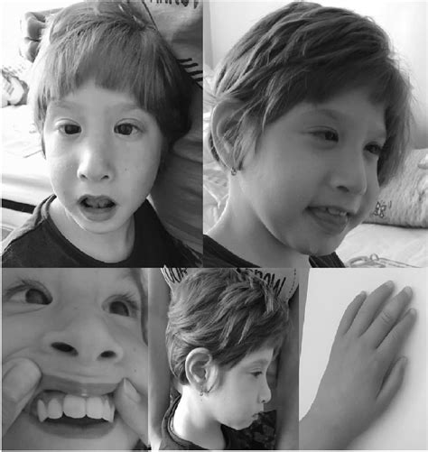 Dysmorphic Features Of The Patient With 16q243 Duplication
