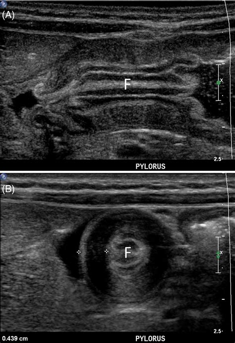 Pylorus Ultrasound