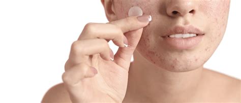 Pimple Patches Werken Ze Echt Sproet
