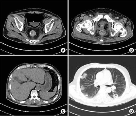 Urinary Bladder Distended Description