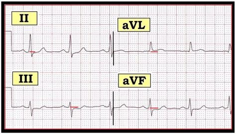 Ecg Interpretation Ecg Interpretation Review 34 Acute Mi Vs