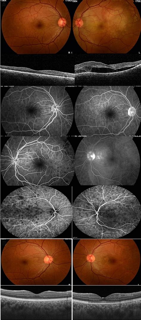 At Presentation Colour Fundus Photographs Of The Right And Left Eyes