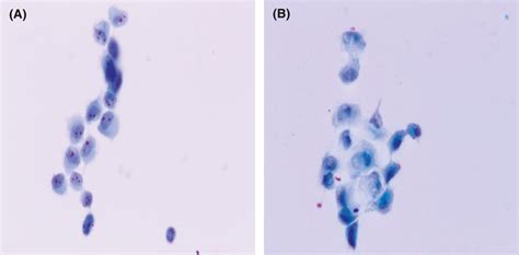 A Atypical Cells With Inconspicuous Nucleoli Speculated As Neoplastic