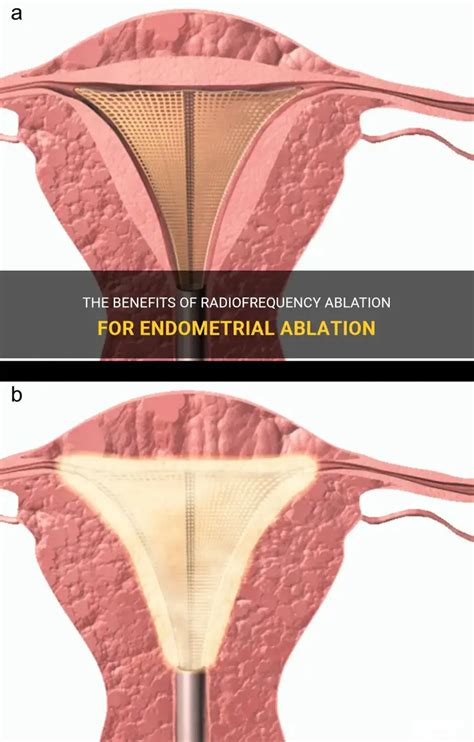 The Benefits Of Radiofrequency Ablation For Endometrial Ablation Medshun