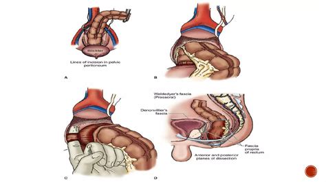Abdominoperineal Resection Pptx