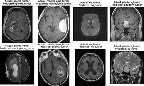 Ensemble Deep Learning Approach For Brain Tumor Classification Using Vision Transformer And