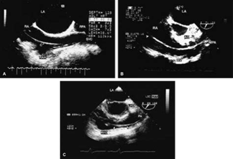 Miscellaneous Lesions Thoracic Key