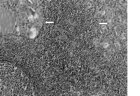 Close Up View Of The Non Tumoral Thyroid Parenchyma Showing Germinal