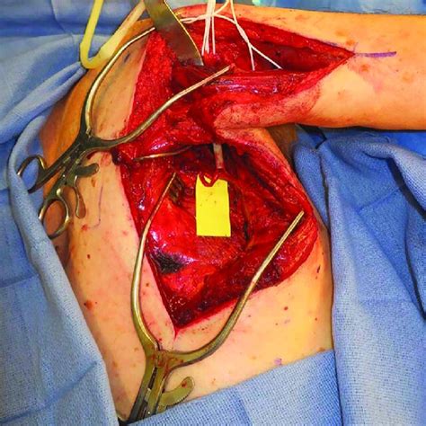 Passage Of The Thoracodorsal Nerve Underneath The Teres Major And