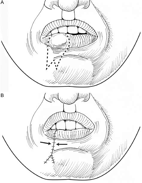 Lip Reconstruction Primary Full Thickness Closure And Superficial