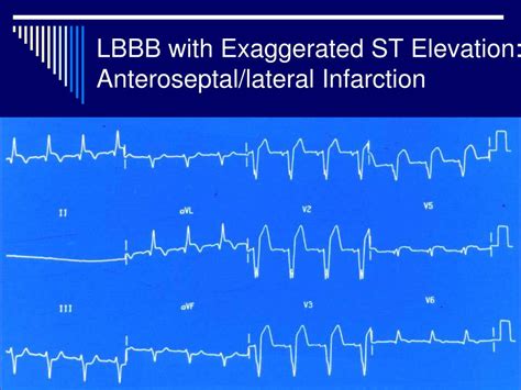Ppt Diagnosis Of Myocardial Infarction Ischemia With Bundle Branch