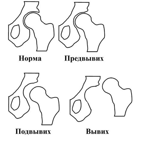 Дисплазия тазобедренного сустава Пикабу
