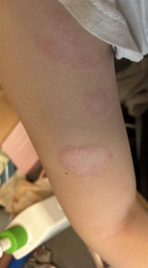 Ringworm Or Something Else R Dermatologyquestions