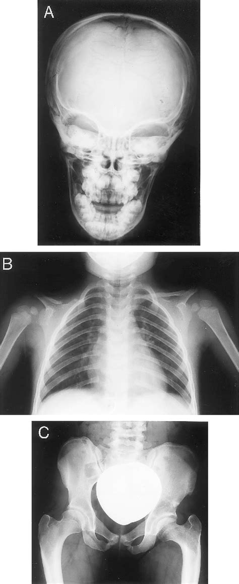 Figure 2 From Mutation Analysis Of Core Binding Factor A1 In Patients With Cleidocranial