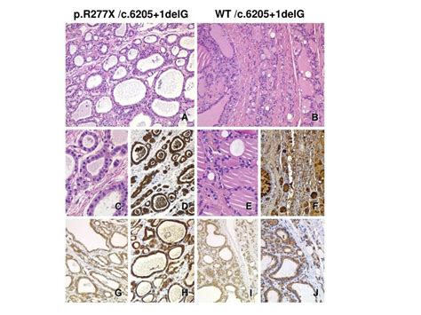 Ppt Goiter Pathophysiology And Clinical Aspects Powerpoint